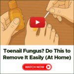 Best Over-the-Counter Toenail Fungus Treatments in 2025 | Top OTC ...