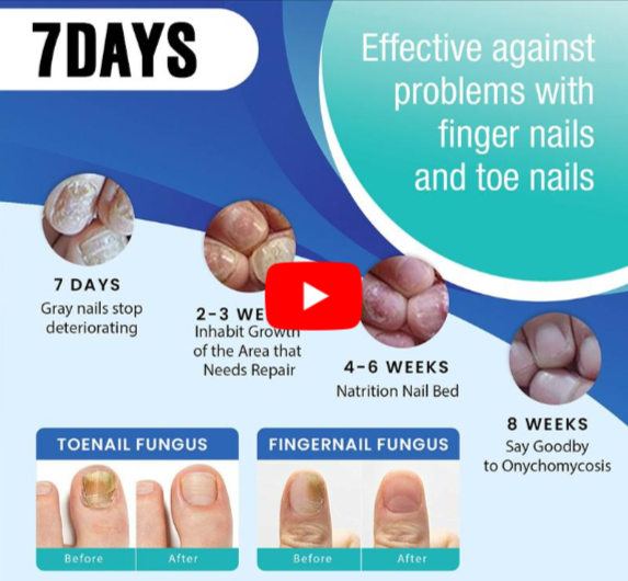 7 Day Nail Fungus Treatment: Fast Relief for Healthy Nails