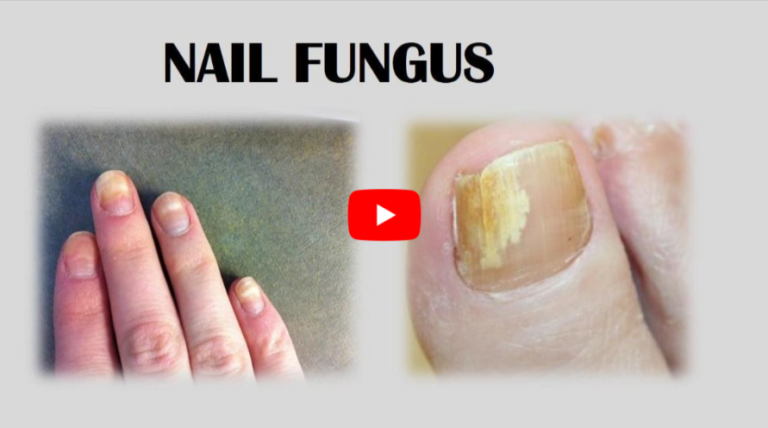 Gingerbread Nails Fungus: Causes, Symptoms & Treatment