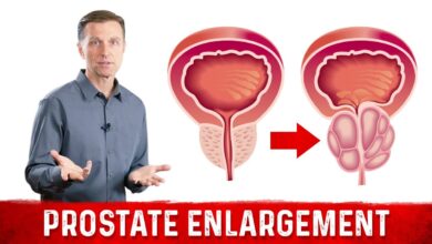 Prostate Artery Embolization: What Men Need to Know